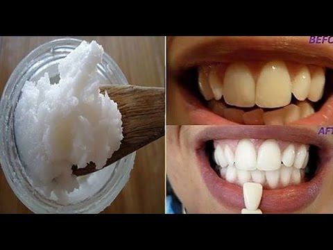 GARGLE WITH ONE SIMPLE INGREDIENT AND SEE WHAT HAPPENS TO YOUR TEETH ...
