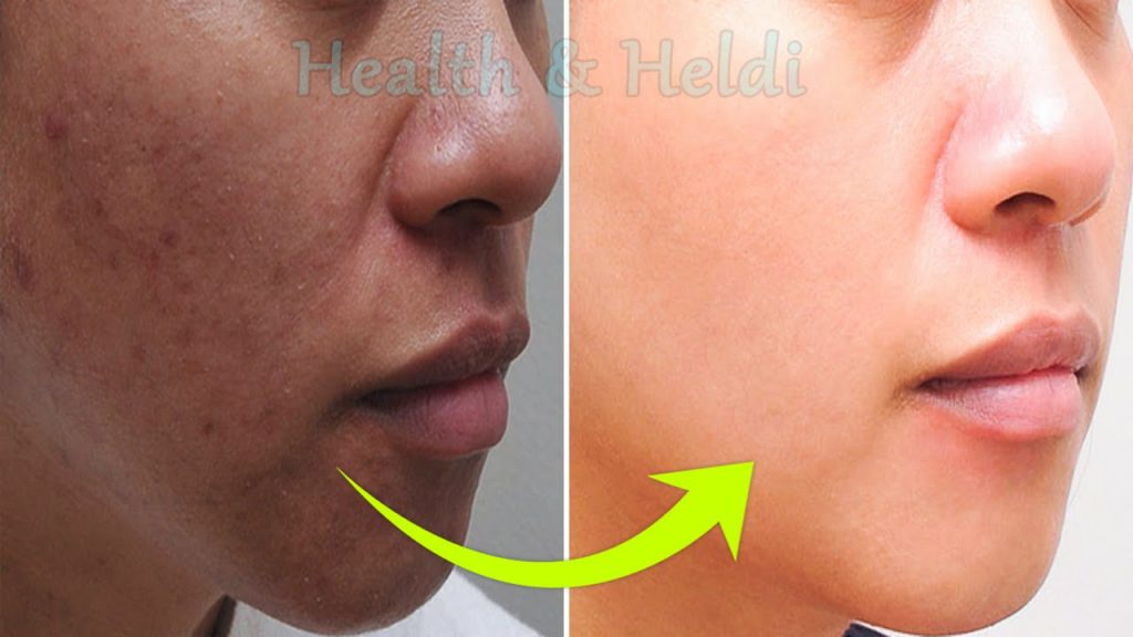 Apply This Face Mask On Your Skin To Get White, Glowing And Spotless ...