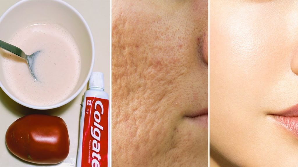 Tomato With Toothpaste Face Mask Close Large Open Pores Remove Dark ...