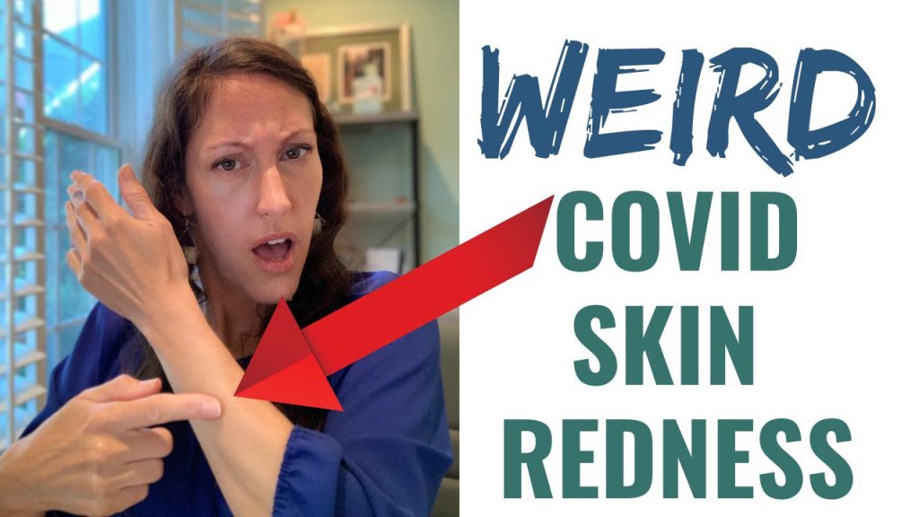 The oddest Symptom of COVID yet…… Learn How to Heal Livedoid & Purporic ...